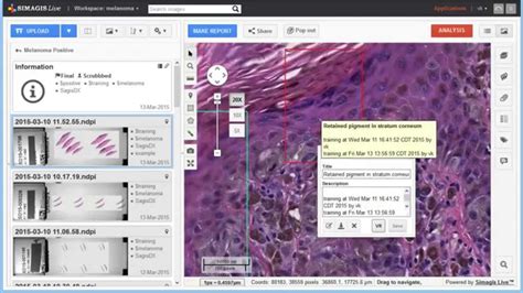 Training Ibm Watson Visual Recognition For Melanoma Patterns Youtube