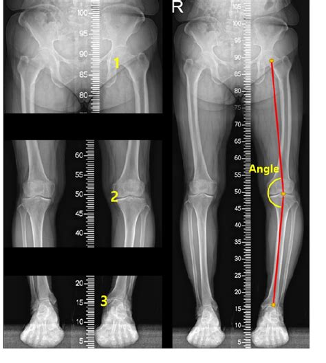 Figure 1 From Measurement Of Lower Extremity Alignment Using A Smartphone Application Semantic