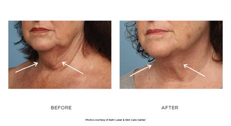 Z Plasty Before And After Photos Behr Laser And Skin Care Center