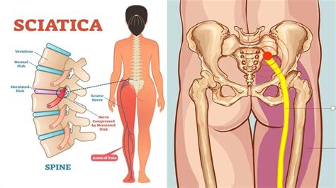 How A Sciatica Chiropractor Can Help