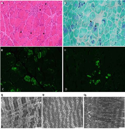 Morphological Analyses Of Patient Skeletal Muscle Tissue A Download Scientific Diagram