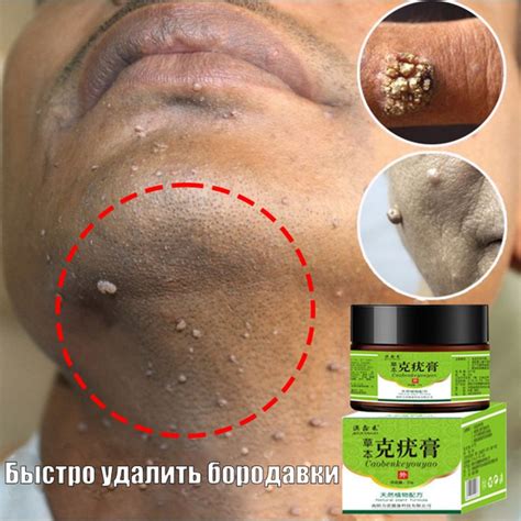 Крем для удаления бородавок и родинок 20г для удаления бородавок папиллом сухих мозолей на