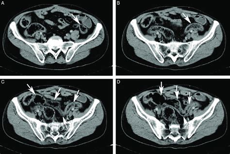 Computed Tomography A B C And D Reveal The Sigmoid Colon Loop Rising Download Scientific