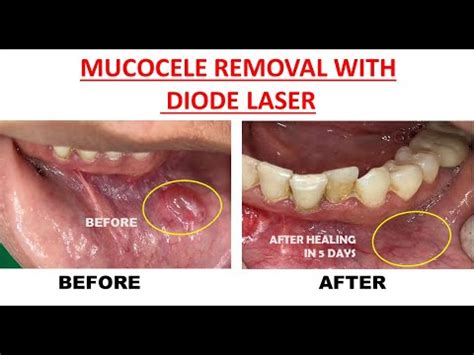 Mucocele Removal With Diode Laser Live Surgery Dr Rohan Virani