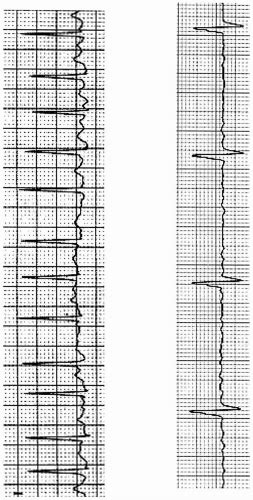 Atrial Fibrillation And Atrial Flutter Thoracic Key