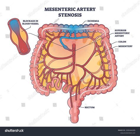 Superior Mesenteric Artery Model