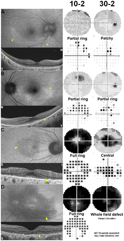 Representative Examples Of Scotoma Patterns Noted In 10 2 And 30 2 Download Scientific Diagram