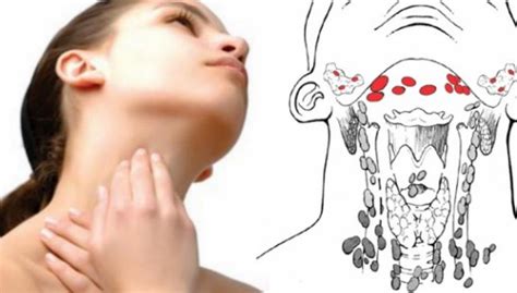 Skin Cancer In Lymph Nodes
