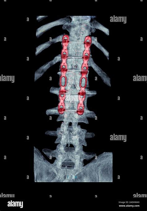 Pinned Broken Spine Coloured Three Dimensional Computed Tomography Ct Scan Of The Pinned