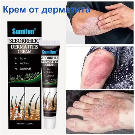 Крем от дерматита для лечения себорейного дерматита псориаза зуда кожи для кожи головы тела