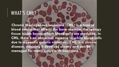 Chronic Myelogenous Leukemia Cml Hematology Pptx