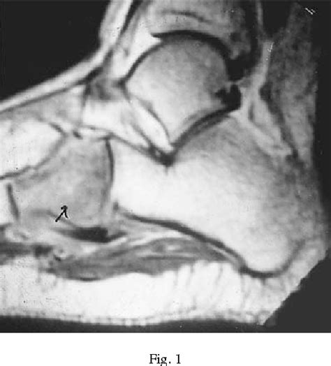 Figure 1 From Tuberculous Osteomyelitis Semantic Scholar