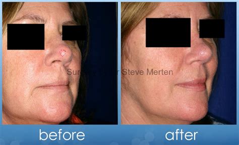 Nasal Cancer Symptoms Mayo Clinic