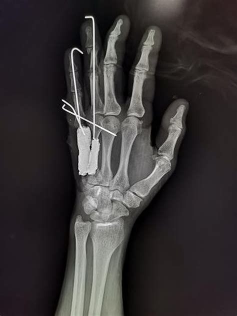 Clinical Effects Of The Modified Masquelet Technique Ijgm