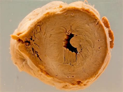 Cardiac Pathology Myocardium Concentric Hypertrophy Hypertension