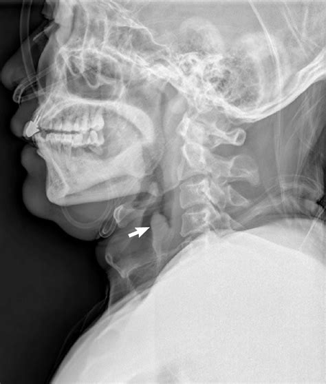 Arytenoid Cartilage Xray