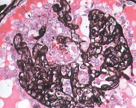 Global Glomerulosclerosis