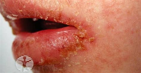 Angular Cheilitis Images Dermnet Nz