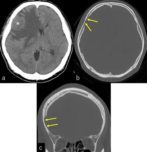 A Axial Computed Tomography Scan Shows An Isodense Mass In The Right Download Scientific