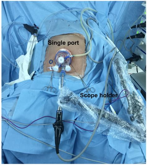 Solo Single Incision Laparoscopic S8 Non‐anatomical Resection And Left