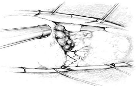 图19 32 位于脊髓侧方的血管母细胞瘤的处理 脊柱手术技术 医学