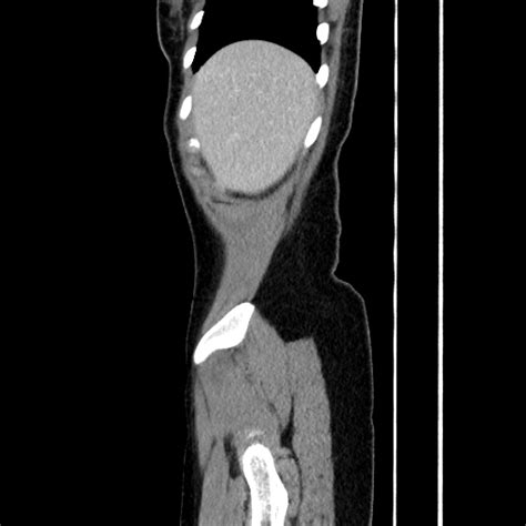 File Crohns Disease Terminal Ileitis Fistulizing Radiopaedia 98245 118784 Sagittal 81 Jpeg