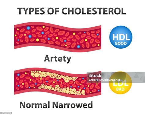 Types Of Cholesterol Comparison With Hdl And Ldl Lipoprotein Labeled Educational Normal And