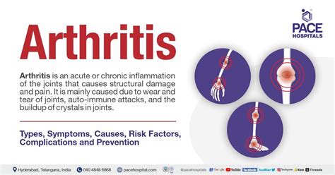 Arthritis Symptoms Types Causes And Risk Factors