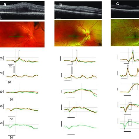 A Patient 1 At 7 Years Of Age Sd Oct Reveals Grossly Abnormal Download Scientific Diagram