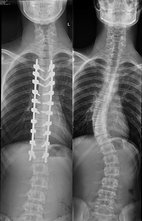 Scoliosis Surgery Before And After X Rays R Pics