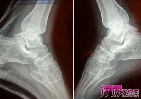 脚骨折后怎样恢复得快图脚骨折后怎样恢复得快 早中晚三期治疗方法介绍 3 伊秀健康 yxlady