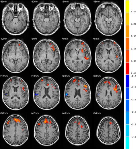 Transverse Section Of Between Group Comparisons Of Stroop Task Brain Download Scientific