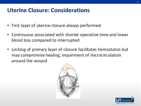 Impact Of Single Versus Double Layer Closure On