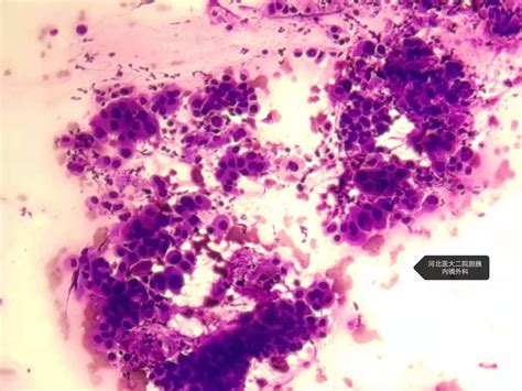胃肠改道术后胰头占位患者的eus Ercp诊治 胆胰内镜网