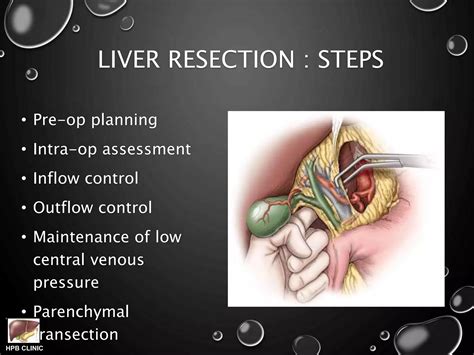 Recent Advances In Liver Resections Pptx