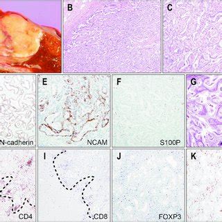 Representative Pathological Features Of Intrahepatic Cholangiocarcinoma Download Scientific