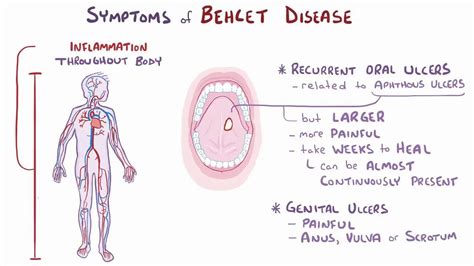 Behcets Disease Video Causes And Meaning Osmosis