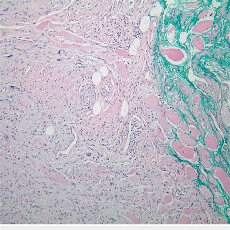 Leiomyosarcoma Tumor Seen Invading Skeletal Muscle Download Scientific Diagram