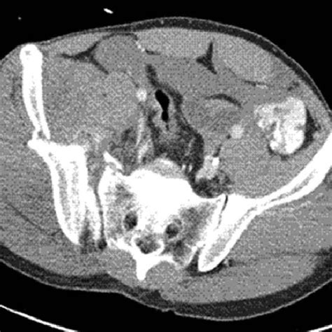 Ct Scan Of The Pelvis Showing Active Contrast Extravasation Of Distal Download Scientific