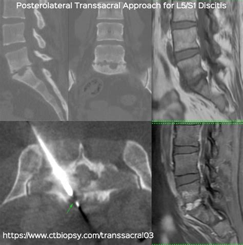 Case 75 L5s1 Discitis Biopsy Using A Posterolateral Transsacral