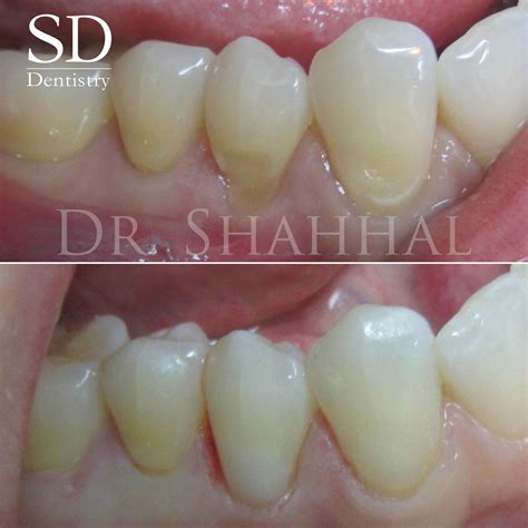 Posterior Composites To Repair Tooth Fracture Near Gums Clenching Or