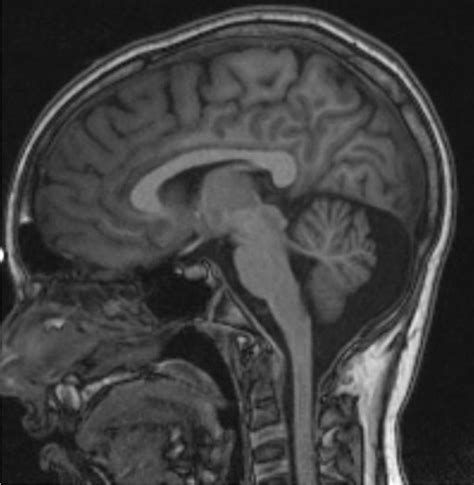 Sagittal T1 Weighted Cerebral Mri Scan Showing Vermian Hypoplasia