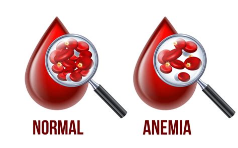 Anemia Causes Symptoms Types Diagnosis And Treatment
