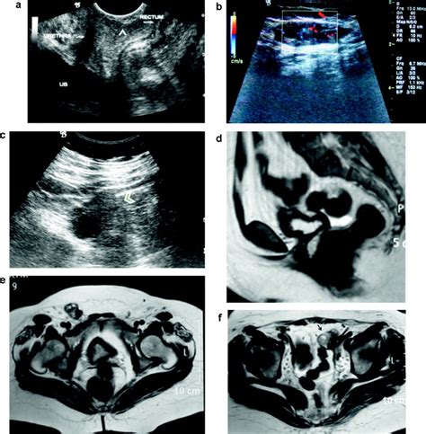 Does Mri Add To Ultrasound In The Assessment Of Disorders Of Sex