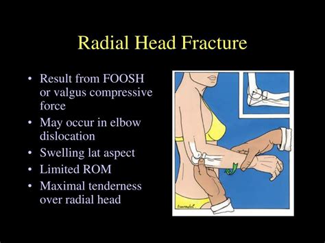 Ppt Management Of Extremity Fractures Powerpoint Presentation Free