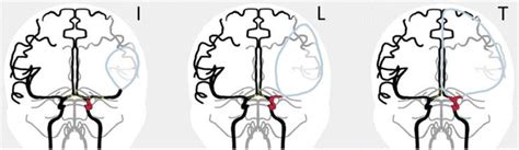 Schematic Diagram Of Ica Terminus Occlusions With I Type Left L Type Download Scientific