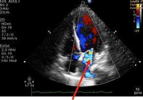 D Echo Doppler Study Dimenstional Echocardiography Doppler Study Peter Yan Cardiology Clinic