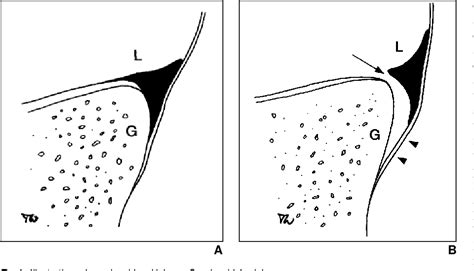 Figure 1 From Perthes Lesion A Variant Of The Bankart Lesion Mr