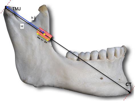 Bony Reference Points Of The Masseteric Nerve Cluster Download Scientific Diagram