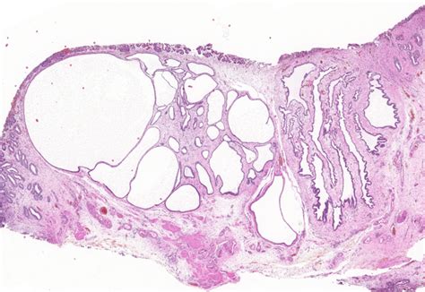 Cystitis Glandularis In A Female Cat 13 Years Of Age